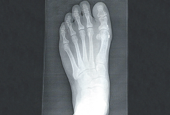 Hallux Varus | Podiatrist Carlsbad | Dr. Keenan Carriero DPM, Encinitas CA