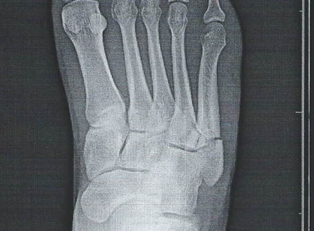 Jones Fracture | Carriero Foot and Ankle - Encinitas, CA